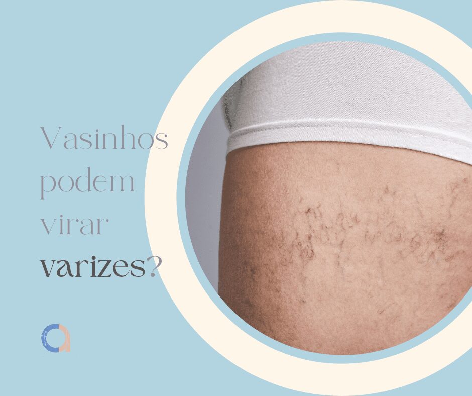 Vasinhos viram varizes? – Dra. Catarina Almeida