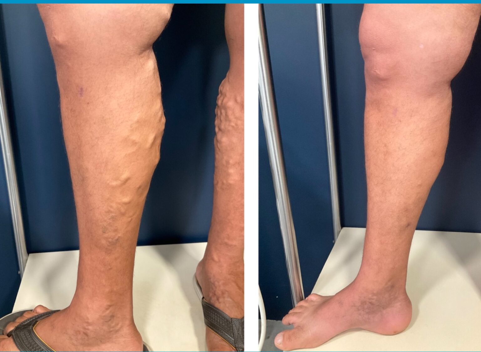 Está em dúvida entre laser e espuma para tratar sua safena?- Dra ...